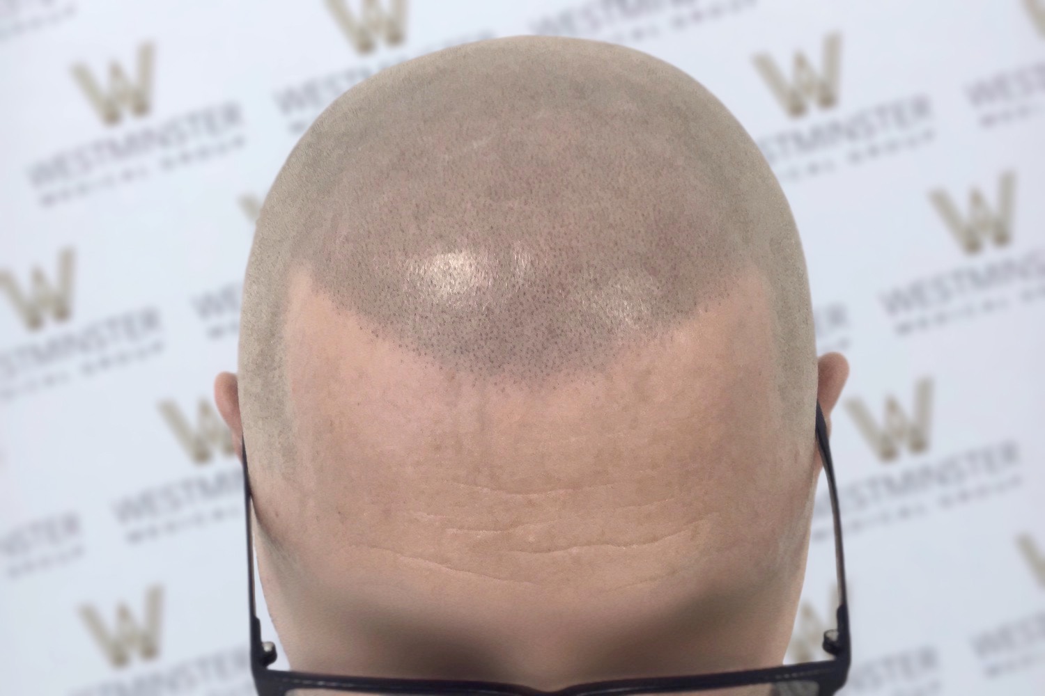 Scalp Micropigmentation London | Westminster Medical Group®